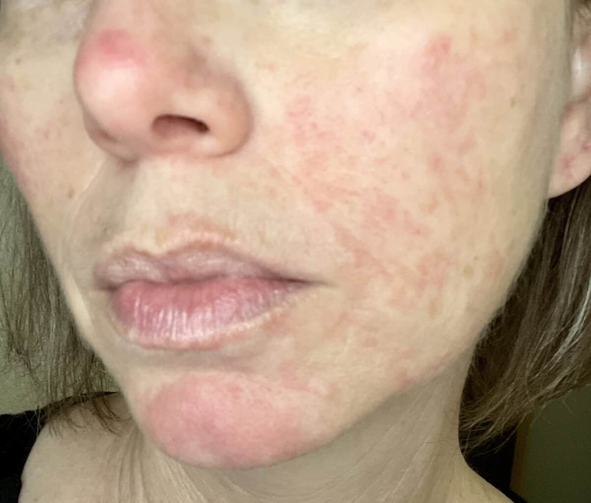 My Top Picks For The Best Foundation For Rosacea And Sensitive Skin